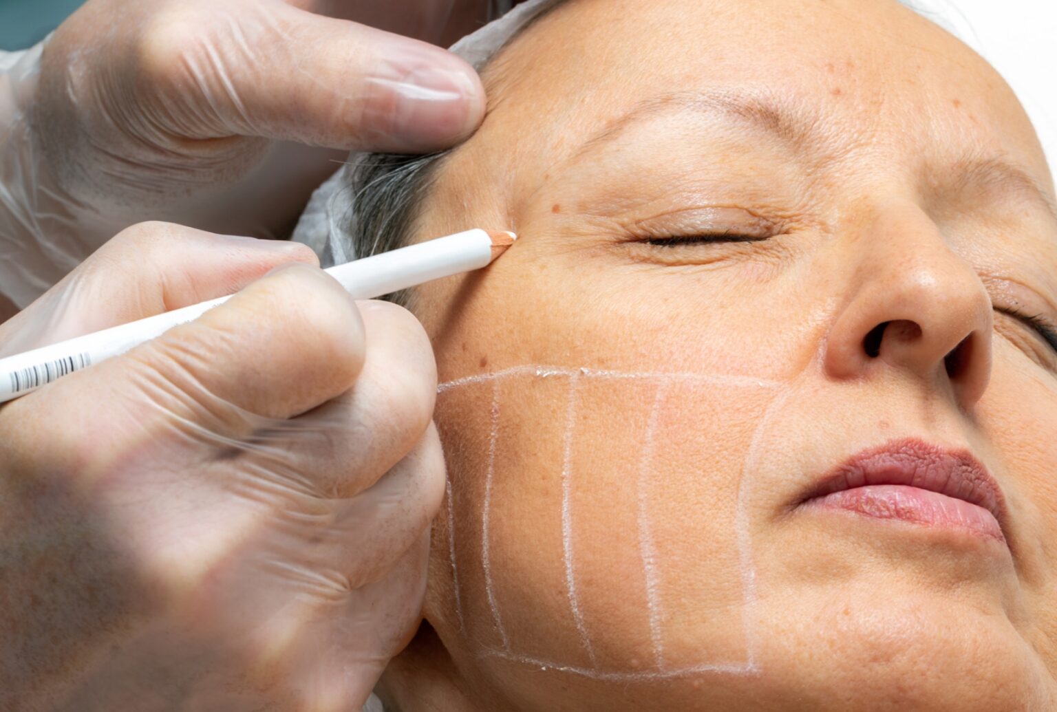 How Acne Scar Fillers Transform Your Skin - FotoLog