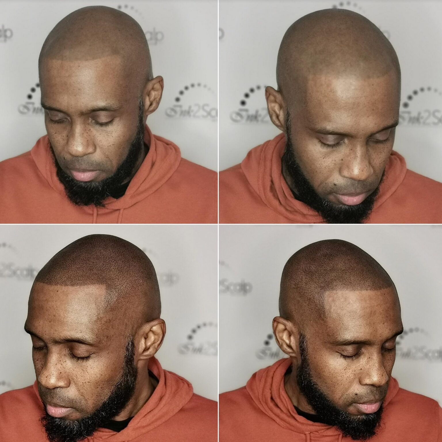 Scalp Micropigmentation Touchup Sessions: When and Why - FotoLog